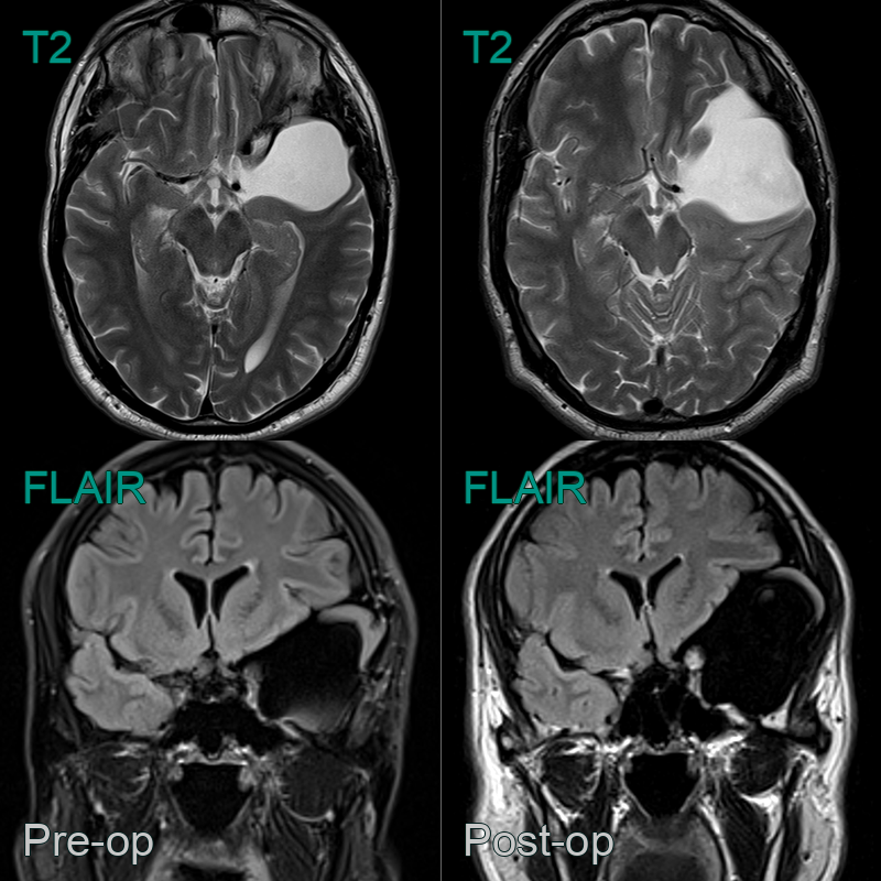 Arachnoid Cyst Neuroradiology