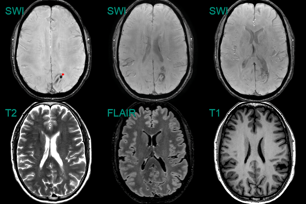 Developmental Venous Anomaly (DVA) - NEURORADIOLOGY Developmental Venous Anomaly (DVA) - NEURORADIOLOGY