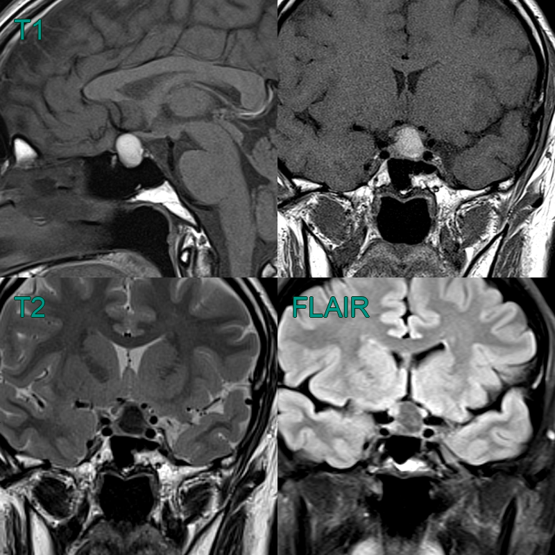 Rathkes Cleft Cyst Neuroradiology